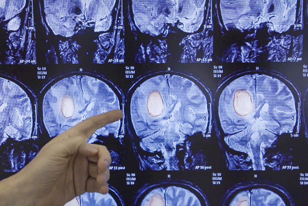 Head Tumor Head Tumor Symptoms Head Tumor Head Tumor Symptoms