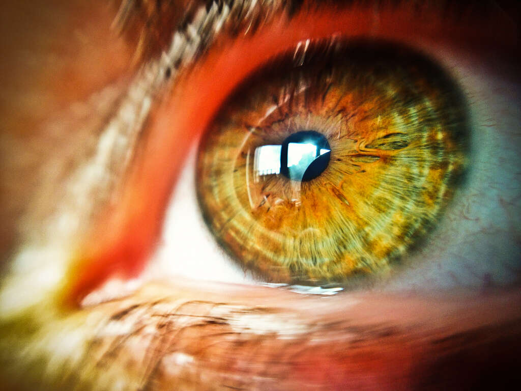 Astigmatism 10 Astigmatism Symptoms