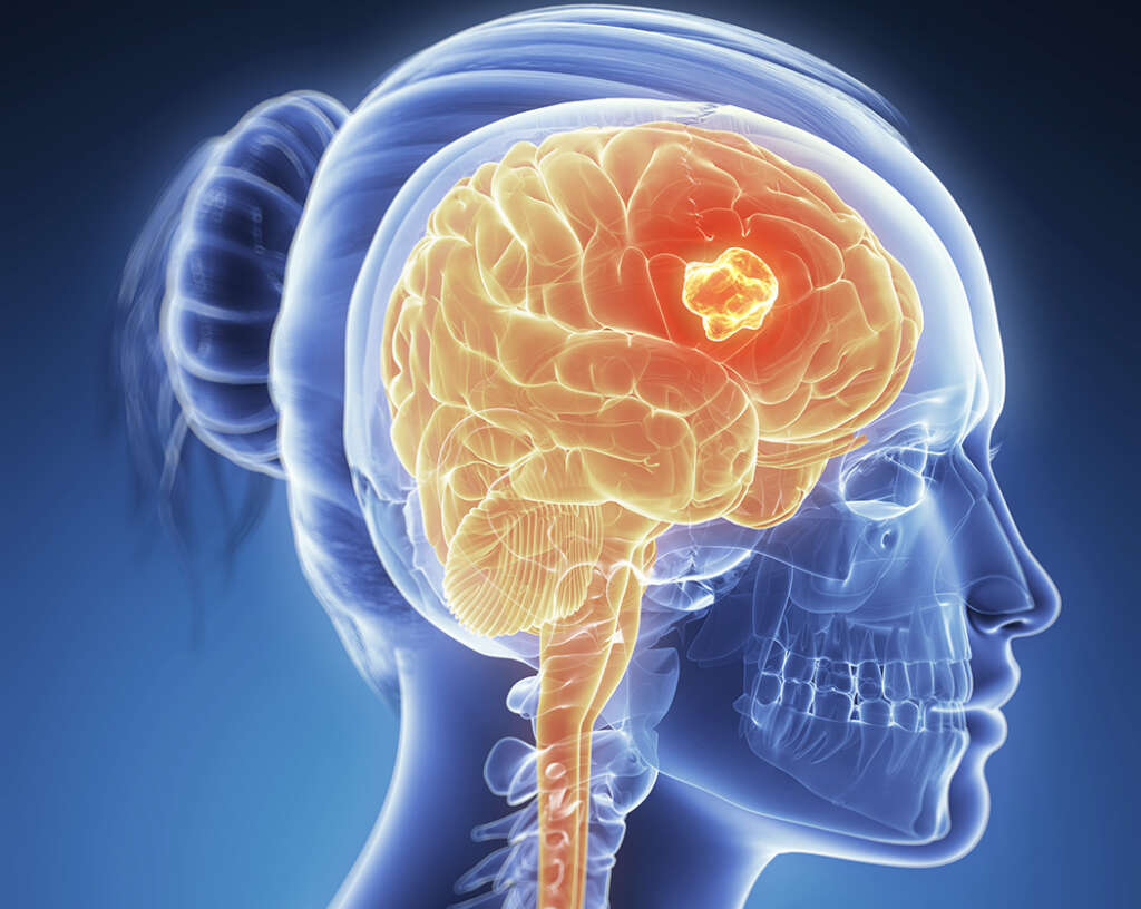 Head Tumor Head Tumor Symptoms Head Tumor Head Tumor Symptoms