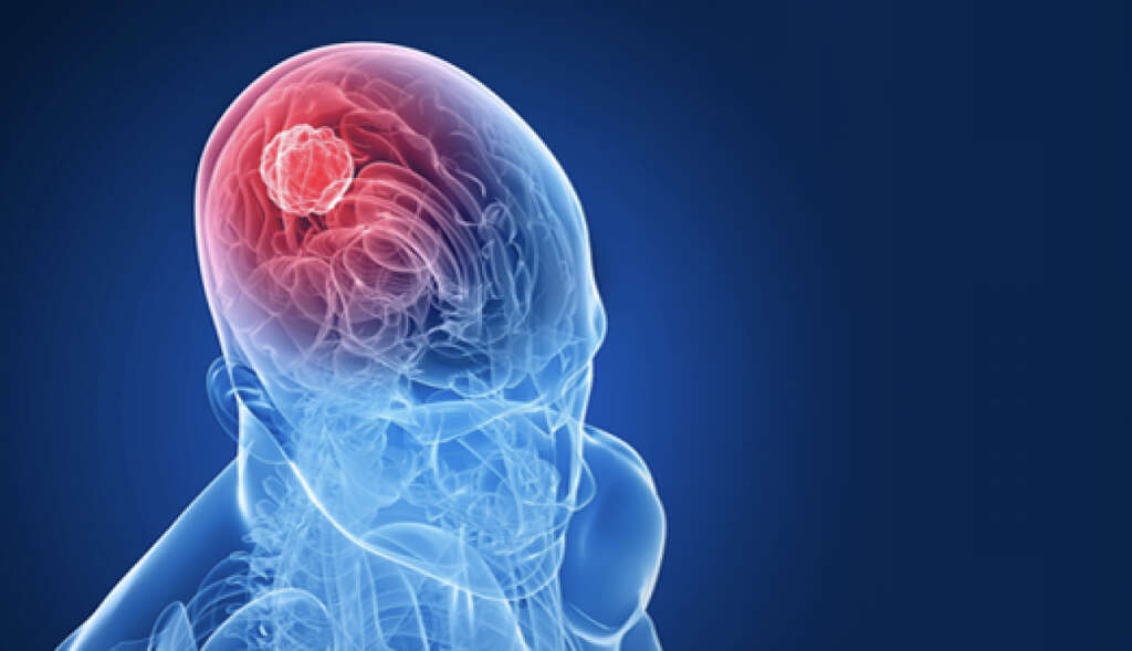 Head Tumor Head Tumor Symptoms Head Tumor Head Tumor Symptoms