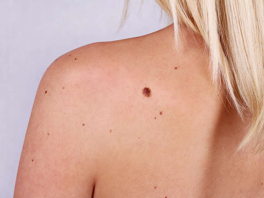 Skin Cancer 10 Symptoms Of Skin Cancer Skin Cancer 10 Symptoms Of Skin Cancer