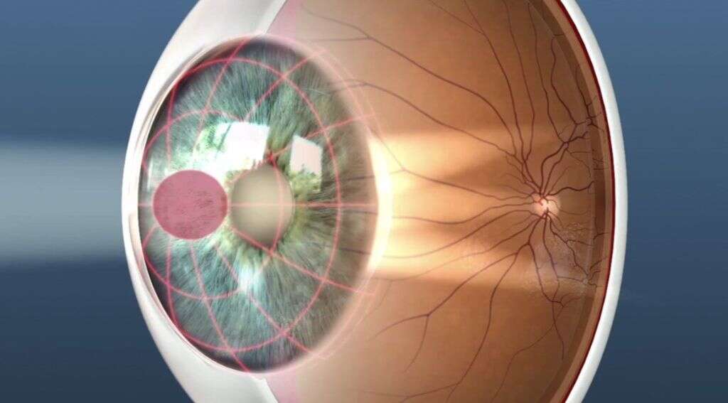 Astigmatism What Is Astigmatism 