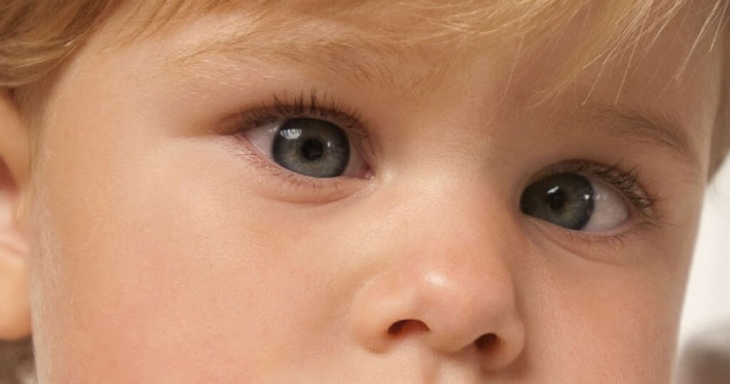 Lazy Eye What Is Lazy Eye Lazy Eye What Is Lazy Eye