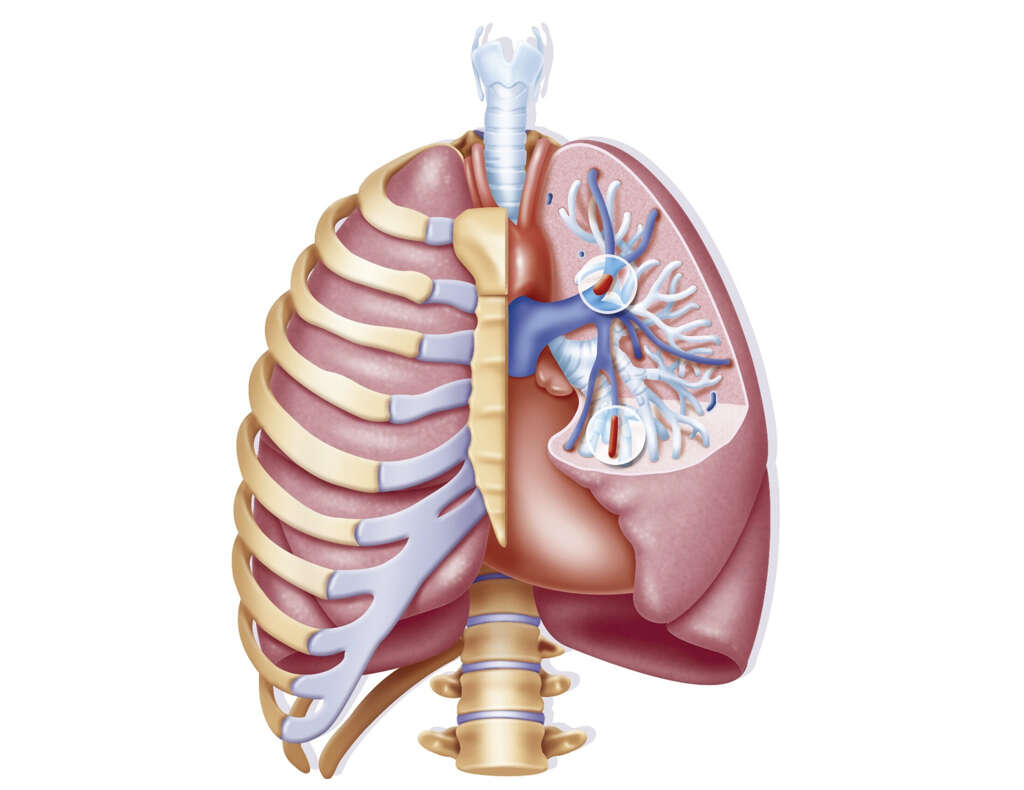 Pulmonary Edema What Is Pulmonary Edema Pulmonary Edema What Is Pulmonary Edema