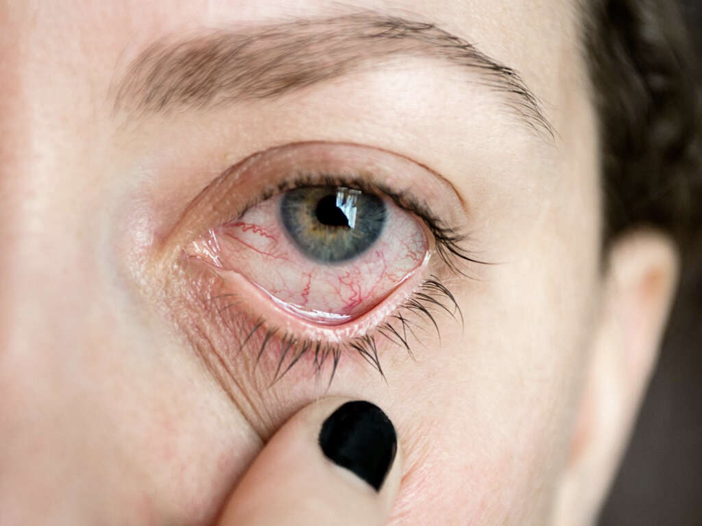 Bloodshot Eyes What Causes Bloodshot Eyes 